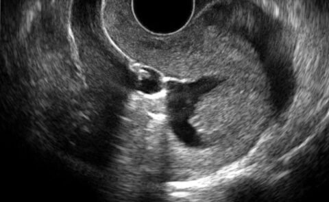 Sonohysterograms - Gynecology Services Littleton, CO | Health ...